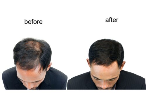 Microneedling For Hair Loss: Effective Scalp Treatment
